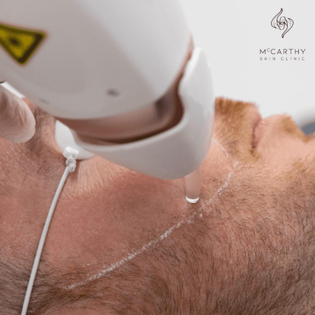 Laser Hair Removal - McCarthy Skin Clinic Milton Keynes